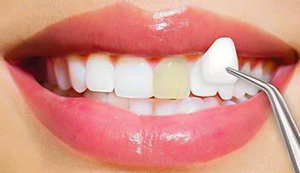 5 Problems That Designer Teeth Veneers Will Eliminate – Good Art & Design